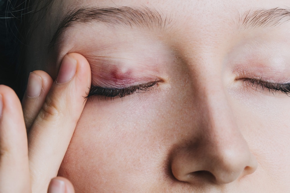 Get rid of uncomfortable stye with the right treatment - Celebrity Surgery